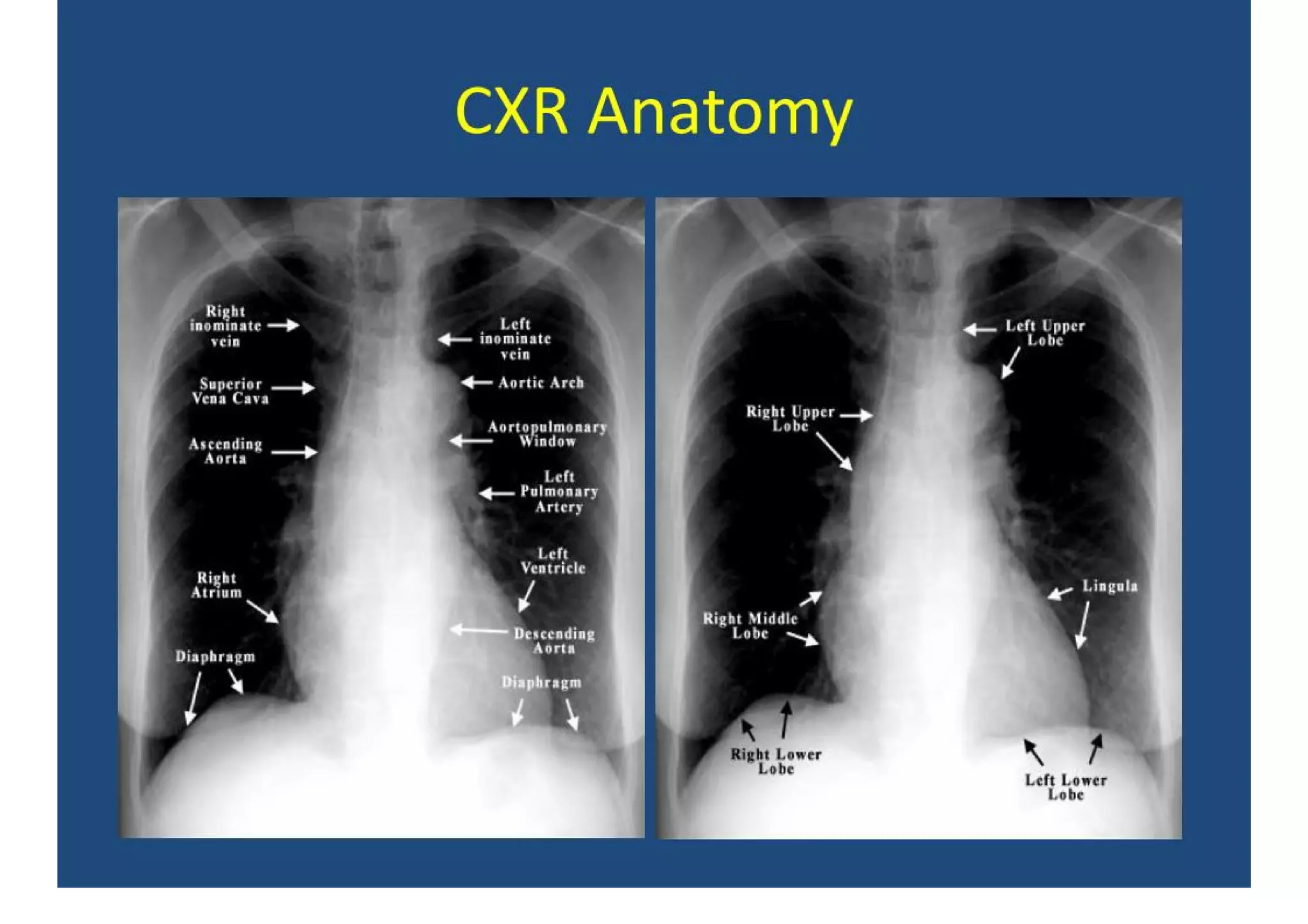 Basics Of Chest X-Ray | PDF