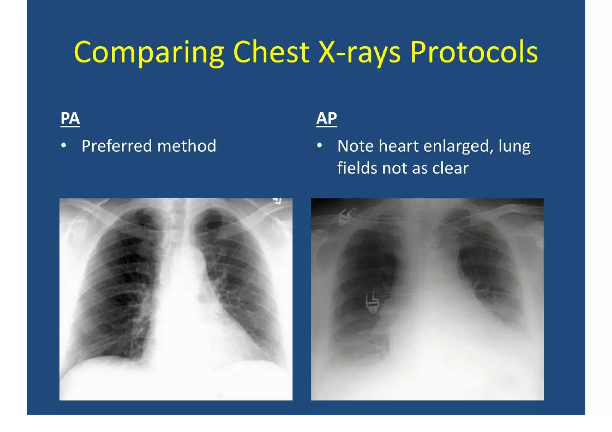 Basics Of Chest X-Ray | PDF