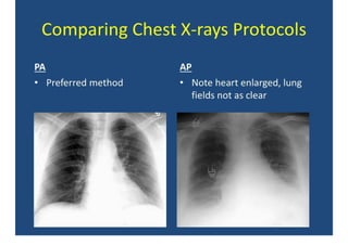 Basics Of Chest X-Ray | PDF