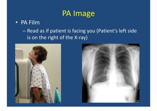 Basics Of Chest X-Ray | PDF