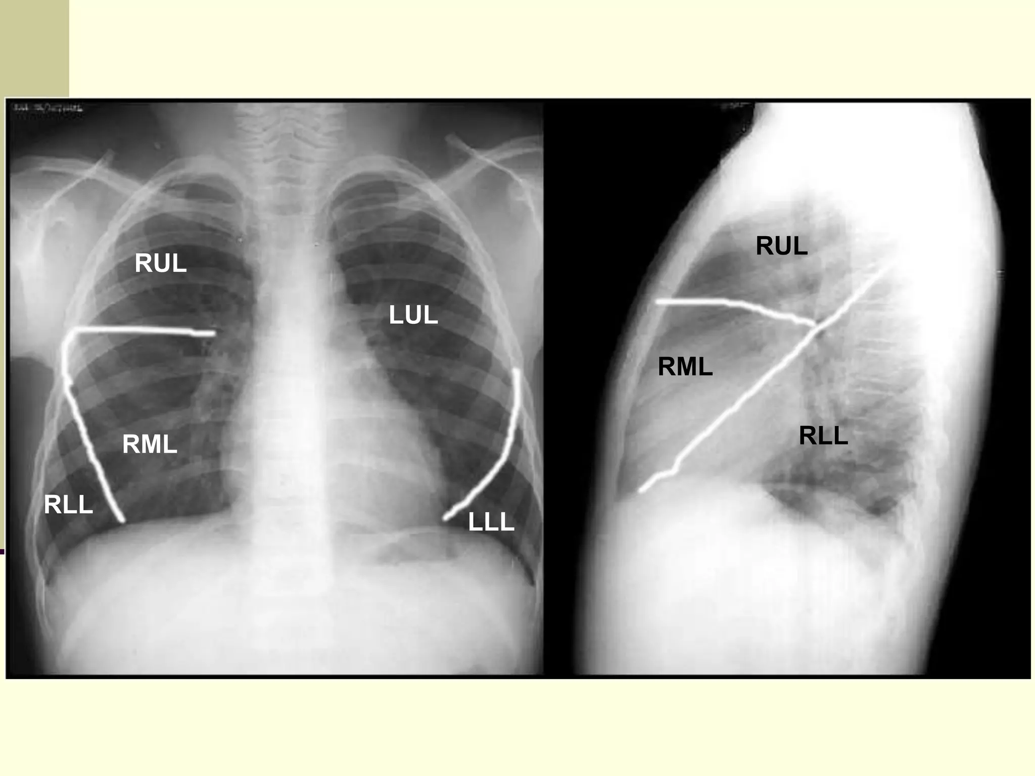 Basics of Chest X-ray Interpretation.pptx