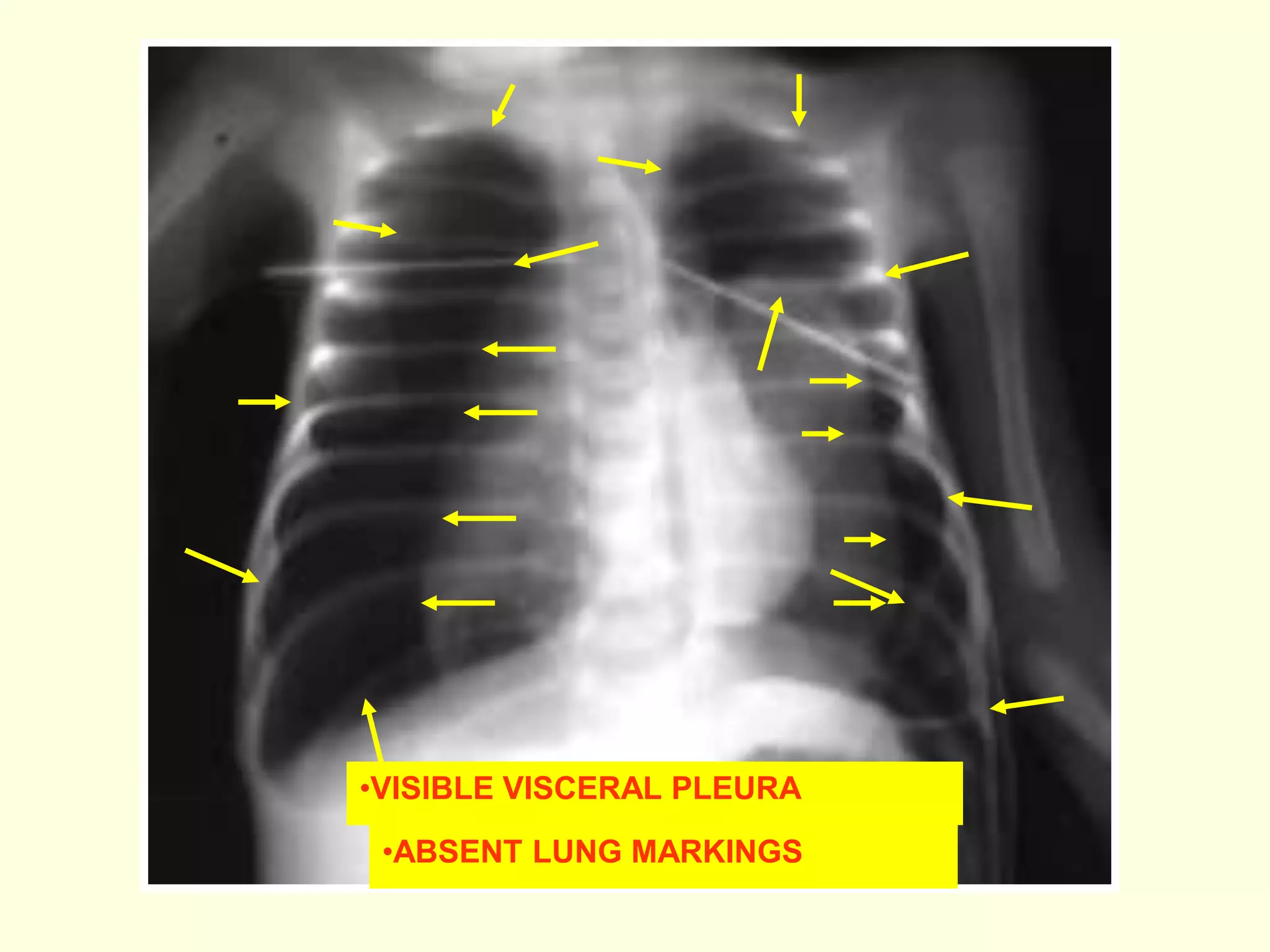 Basics of Chest X-ray Interpretation.pptx