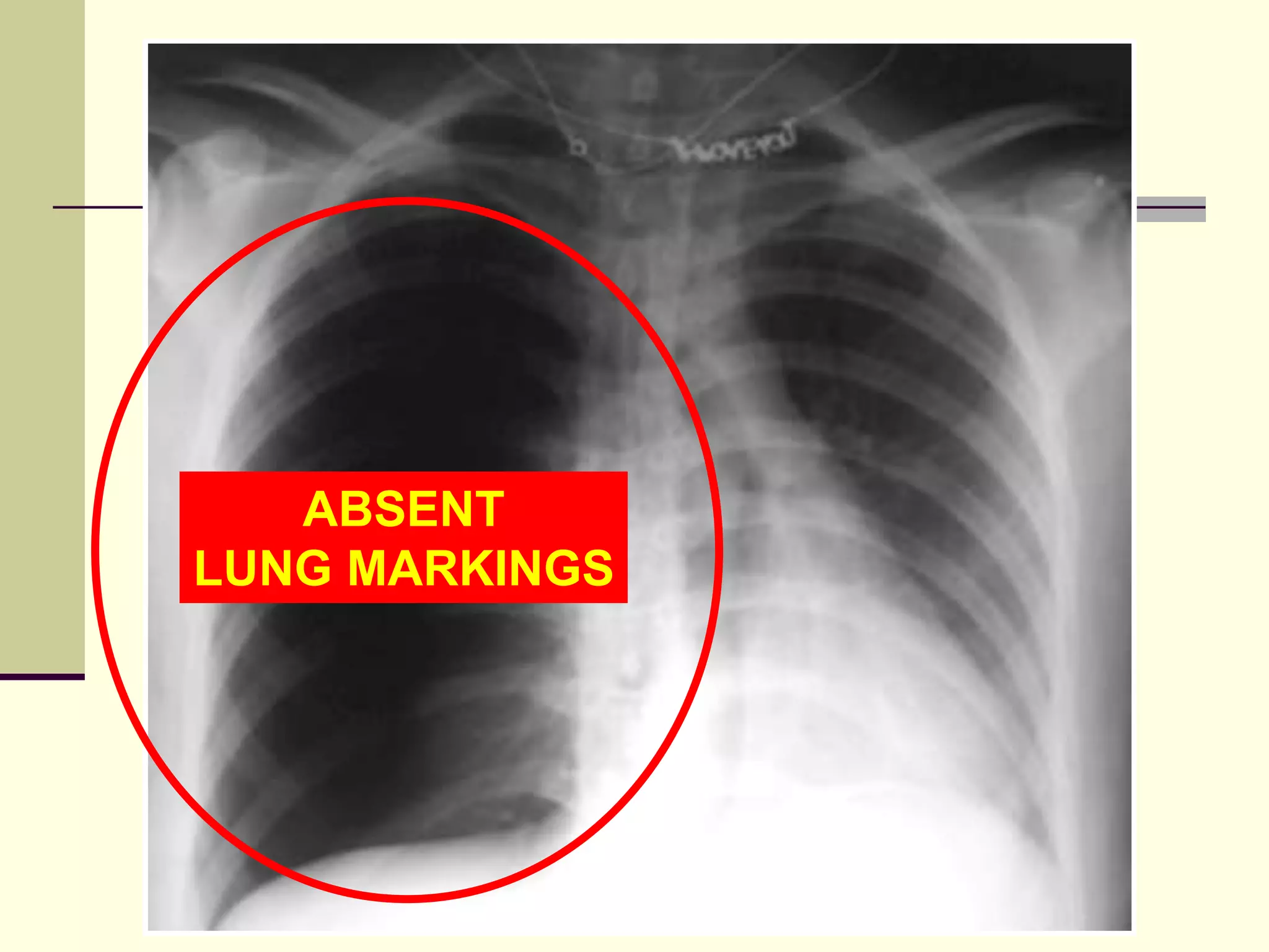 Basics of Chest X-ray Interpretation.pptx