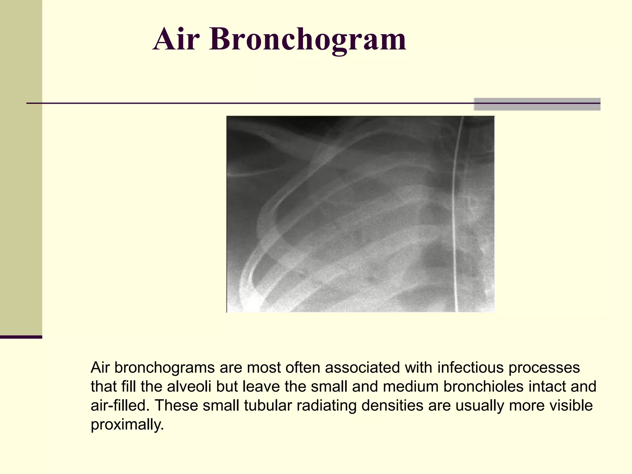 Basics of Chest X-ray Interpretation.pptx