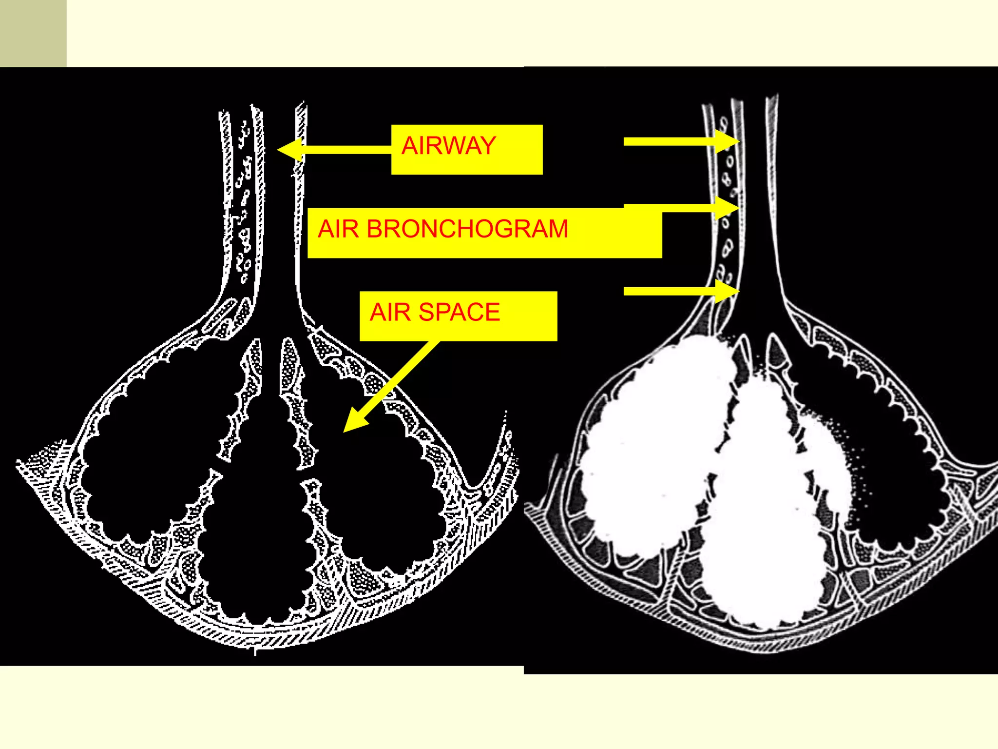Basics of Chest X-ray Interpretation.pptx
