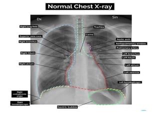 basics_of_chest_xray.pptx basic of chest x ray | PPTX
