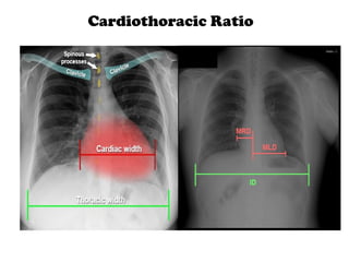 basics_of_chest_xray.pptx basic of chest x ray | PPTX