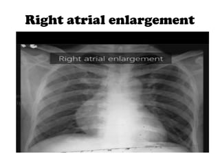 basics_of_chest_xray.pptx basic of chest x ray | PPTX