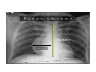 basics_of_chest_xray.pptx basic of chest x ray | PPTX