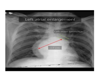 basics_of_chest_xray.pptx basic of chest x ray | PPTX