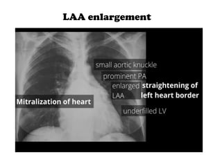 basics_of_chest_xray.pptx basic of chest x ray | PPTX