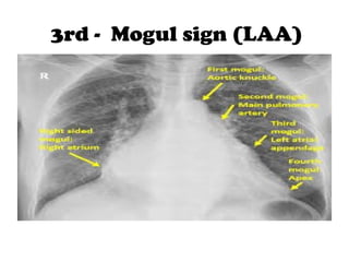 basics_of_chest_xray.pptx basic of chest x ray | PPTX