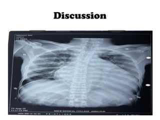 basics_of_chest_xray.pptx basic of chest x ray | PPTX