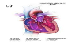 Basics of congenital heart disease | PPTX