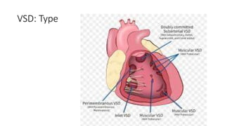 Basics of congenital heart disease | PPTX