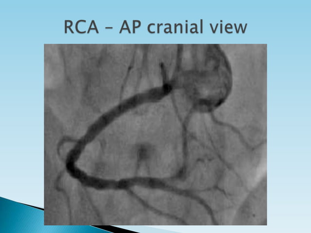 Basics of coronary angiography | PPTX | Heart and Cardiovascular ...