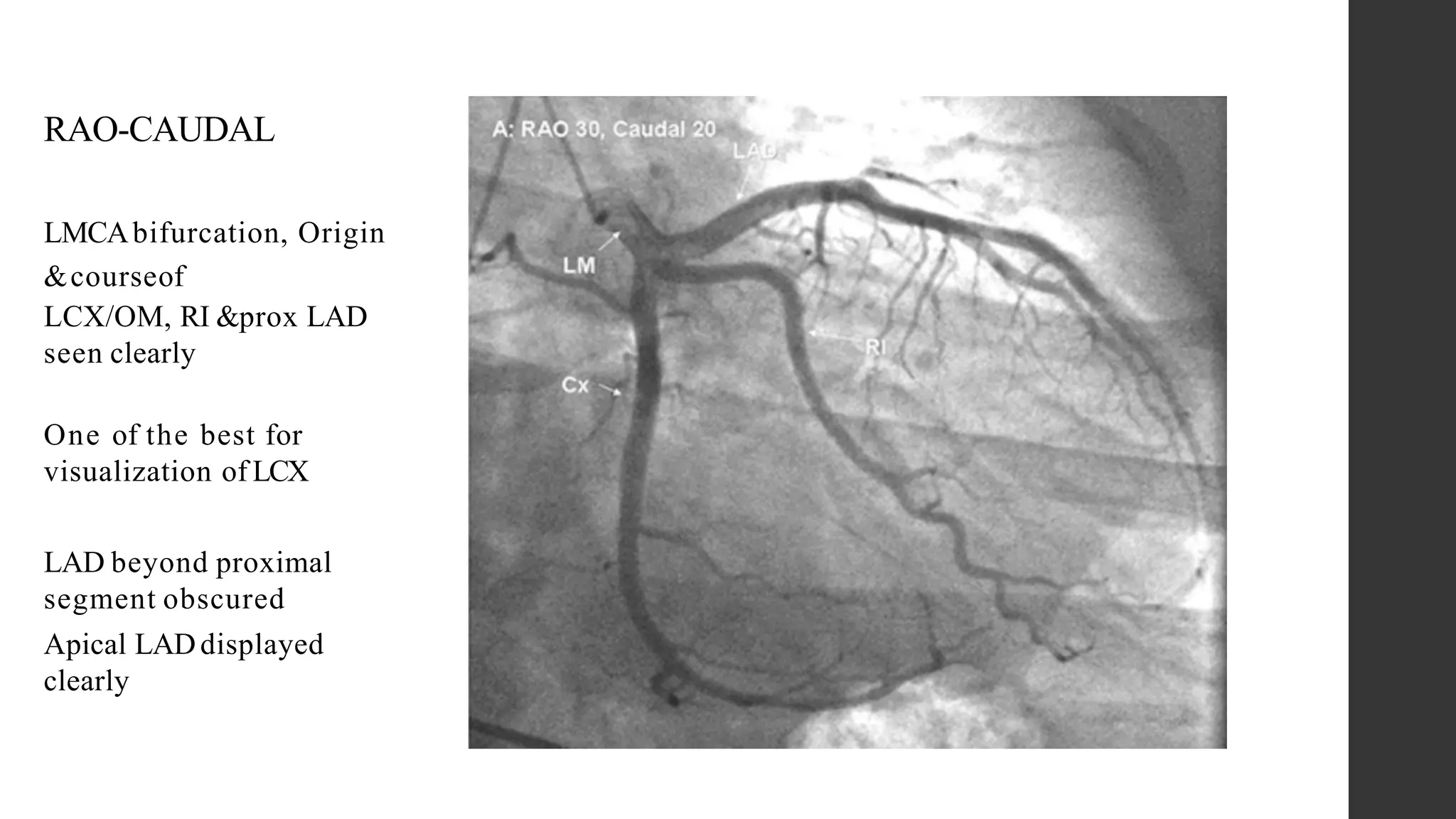 Basics of coronary artery anatomy and angiographic views | PPTX