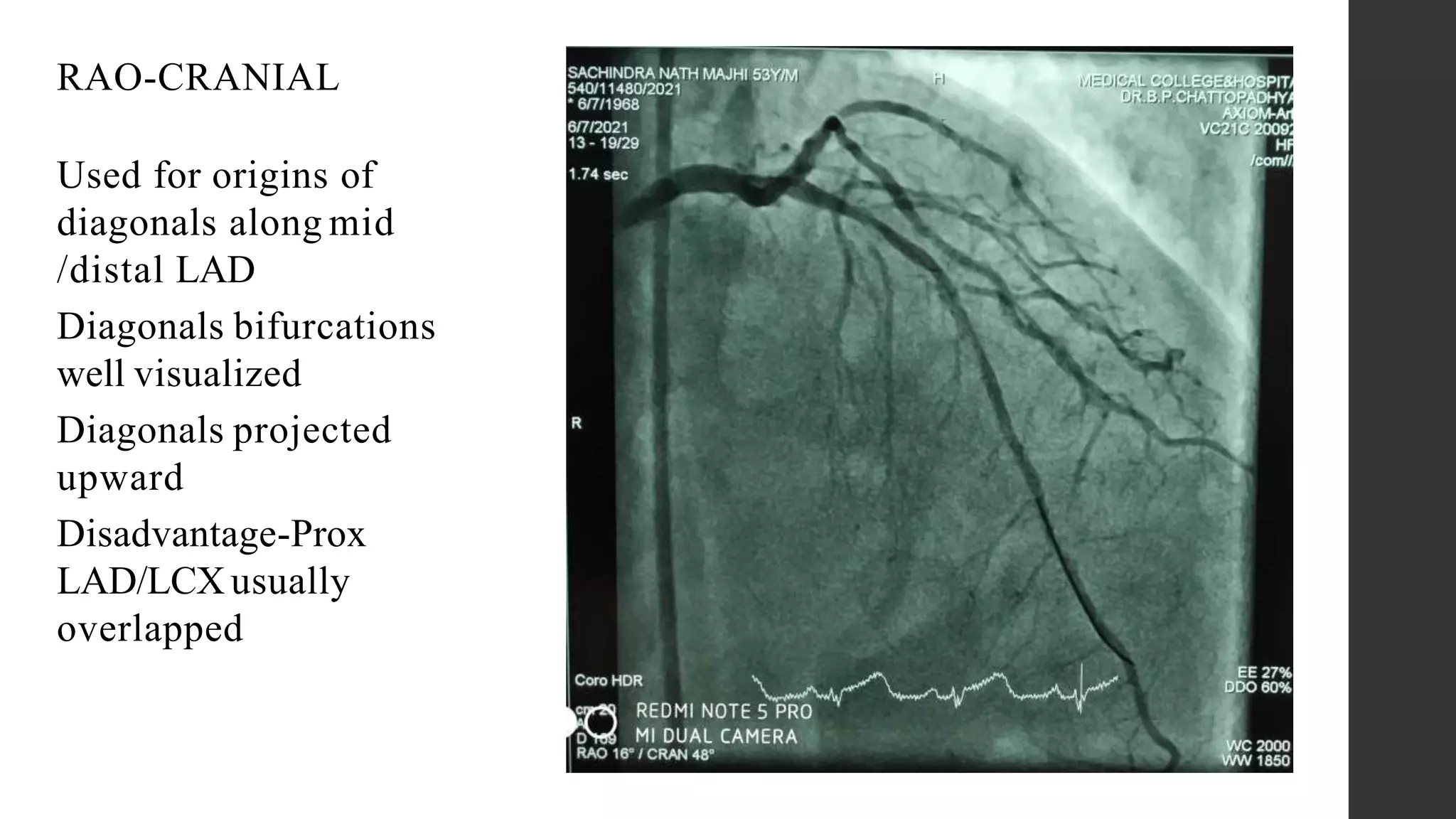 Basics of coronary artery anatomy and angiographic views | PPTX