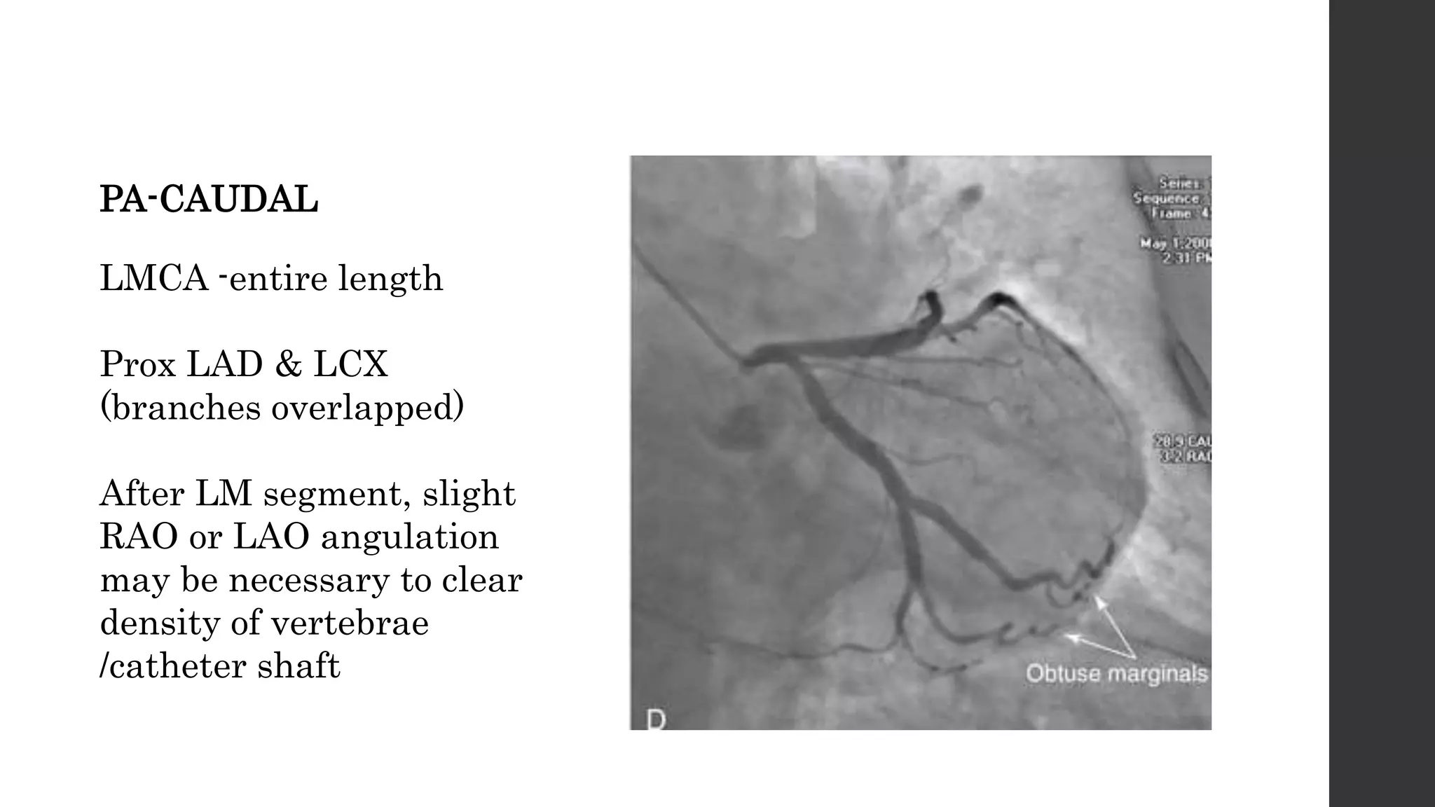 Basics of coronary artery anatomy and angiographic views | PPTX