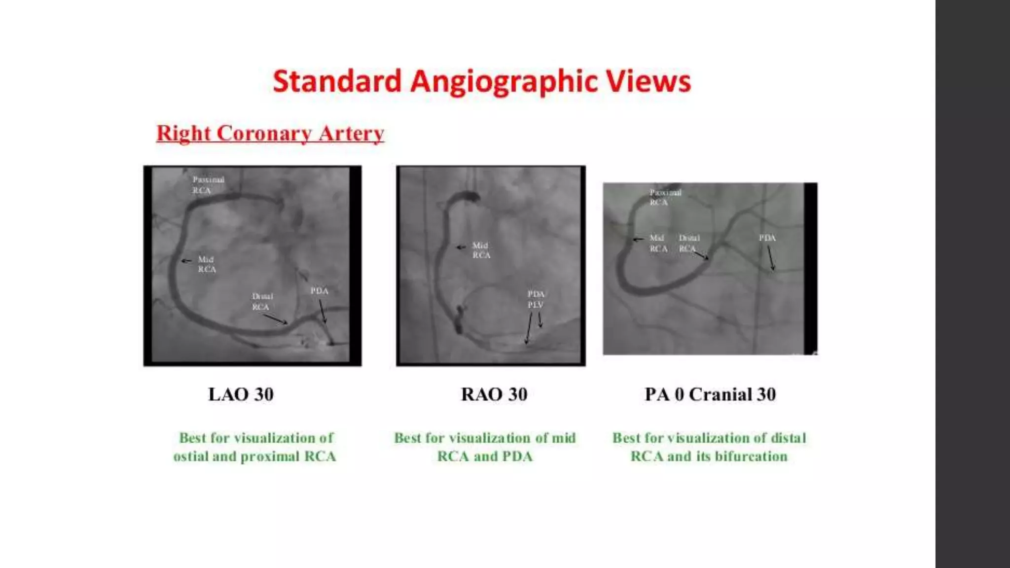 Basics of coronary artery anatomy and angiographic views | PPTX