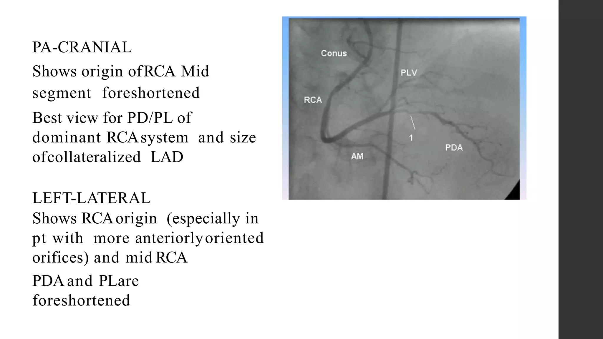 Basics of coronary artery anatomy and angiographic views | PPTX