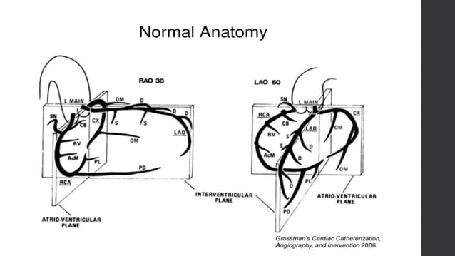 Basics of coronary artery anatomy and angiographic views | PPTX