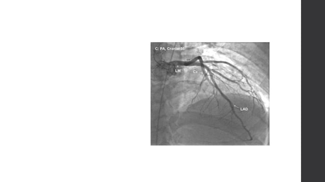 Basics of coronary artery anatomy and angiographic views | PPTX