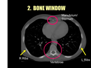 Basics of CT chest including different views and how to read a chest ct ...