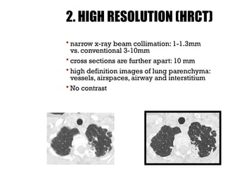 Basics of CT chest including different views and how to read a chest ct ...