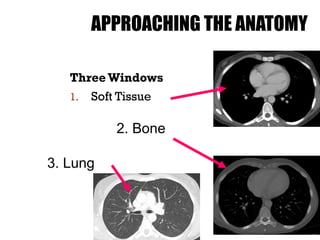 Basics of CT chest including different views and how to read a chest ct ...