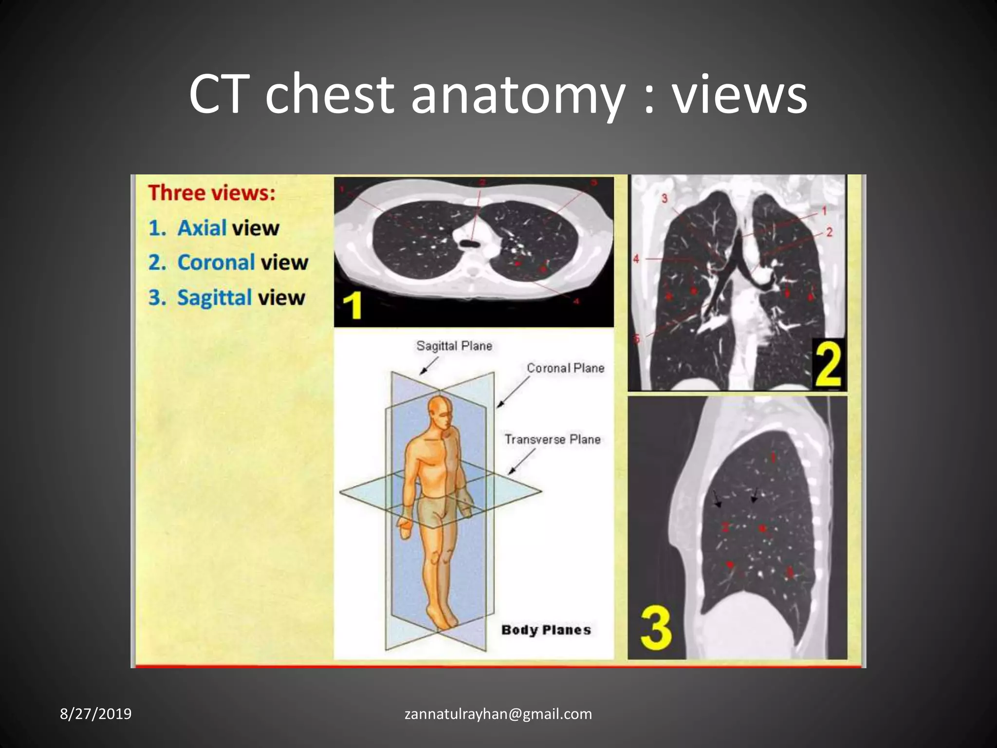 Basics of CT Chest | PPTX