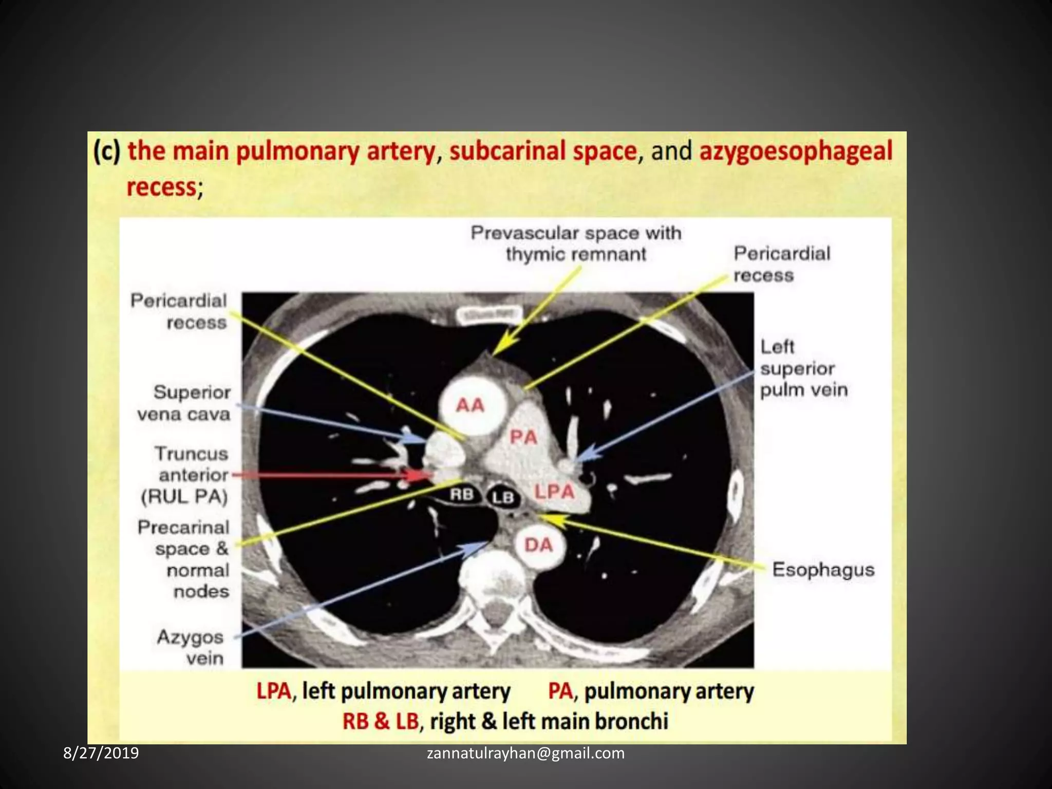 Basics of CT Chest | PPTX