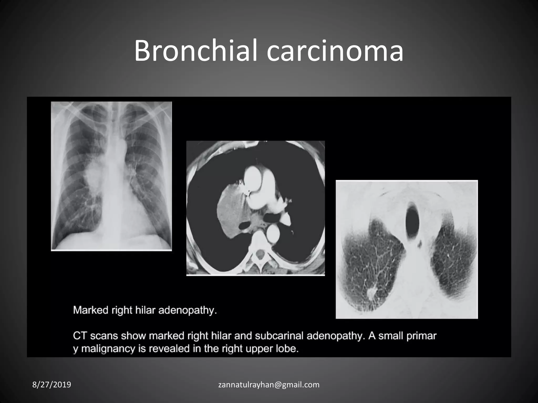 Basics of CT Chest | PPTX