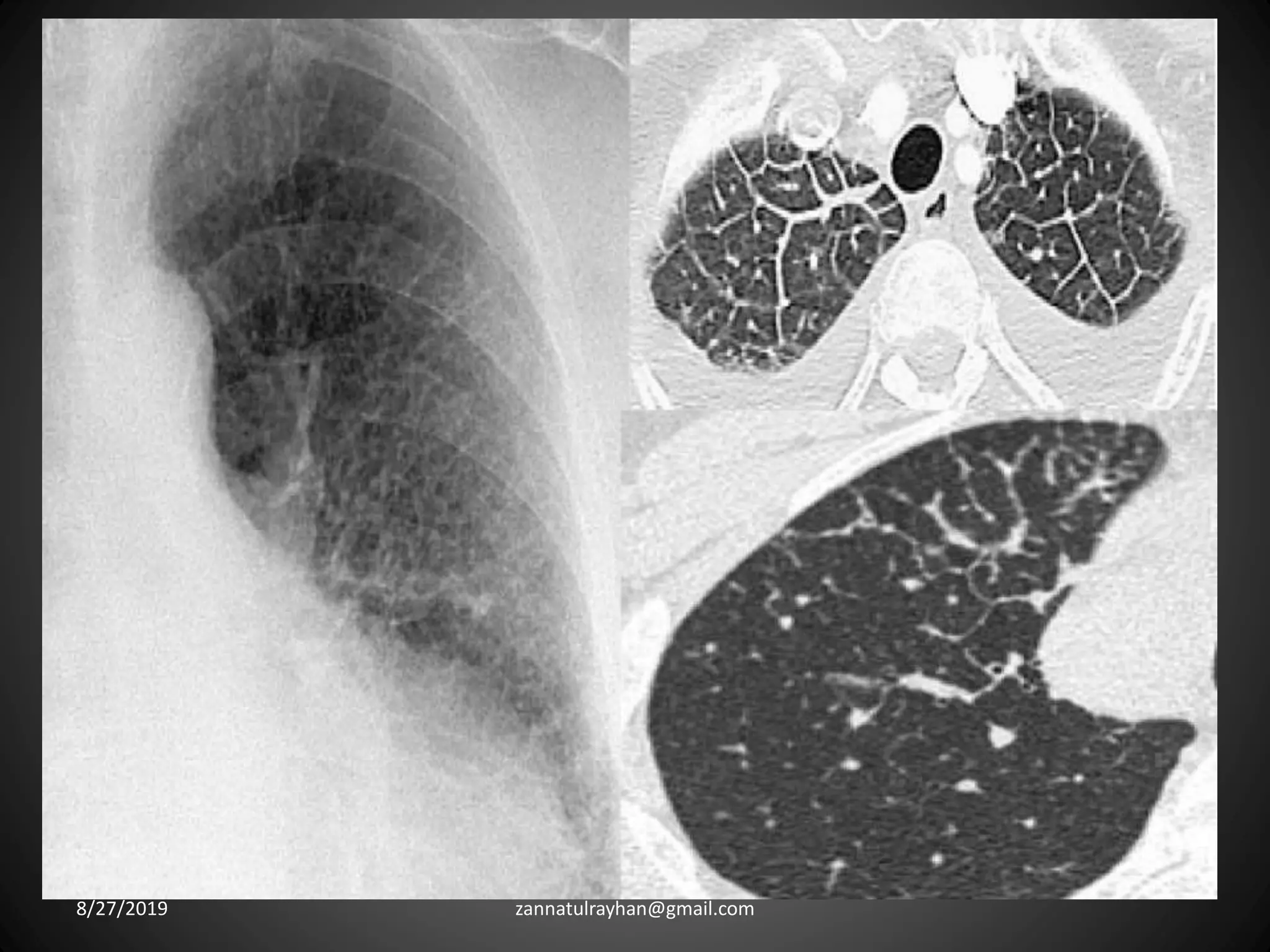 Basics of CT Chest | PPTX