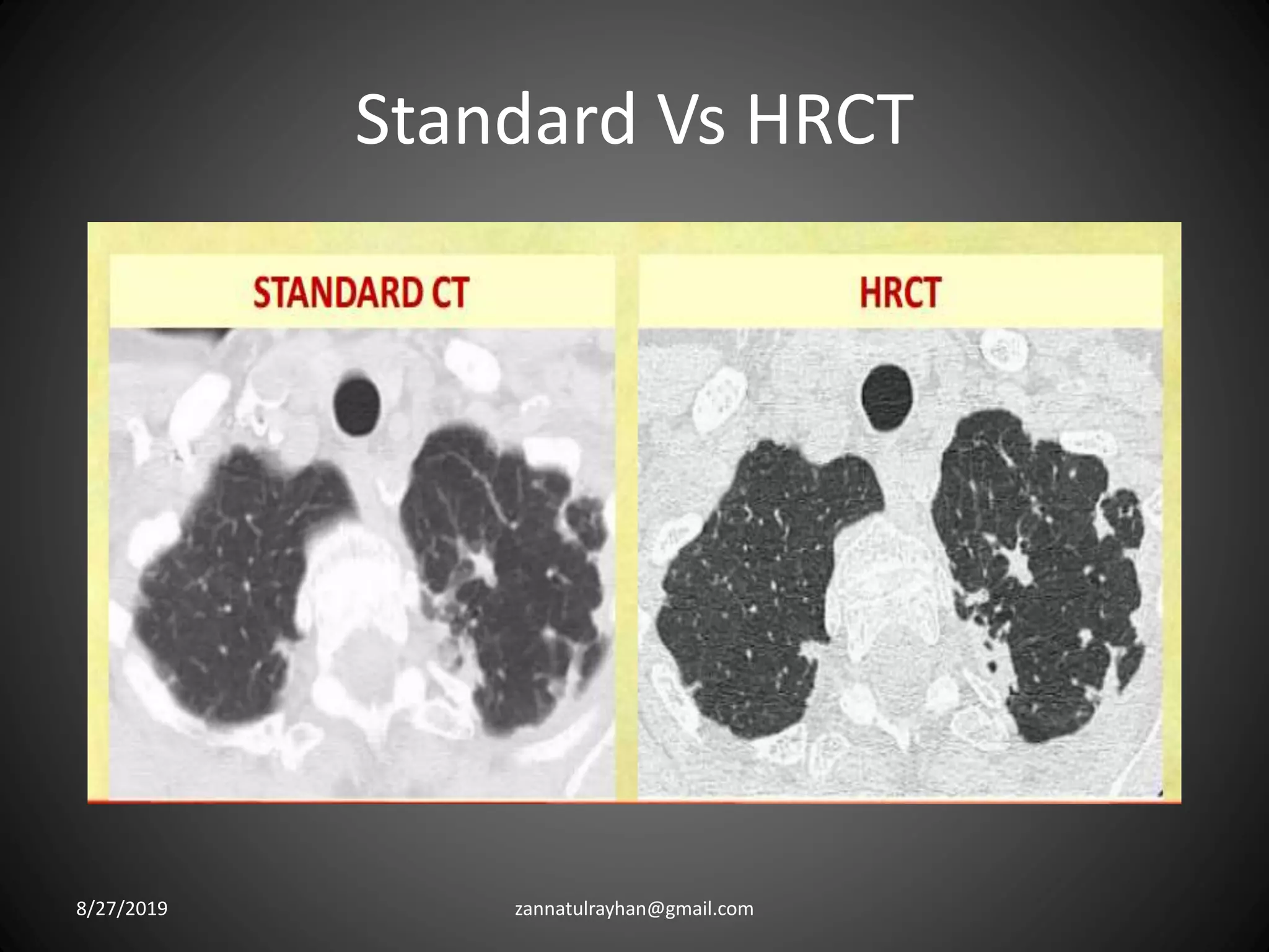 Basics of CT Chest | PPTX