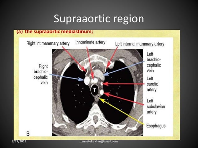 Basics of CT Chest | PPTX