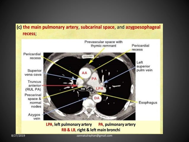 Basics of CT Chest | PPTX