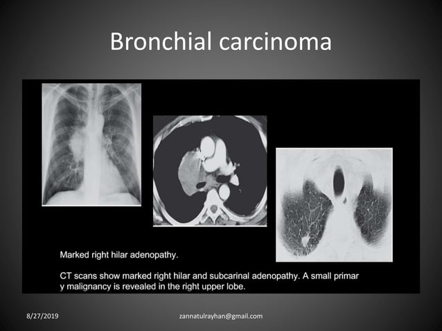Basics of CT Chest | PPTX