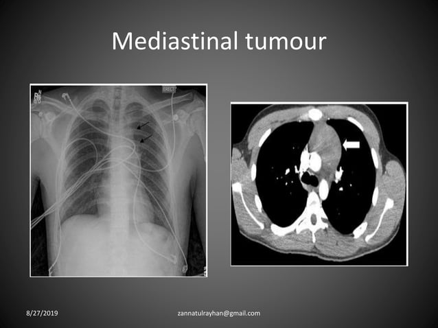 Basics of CT Chest | PPTX