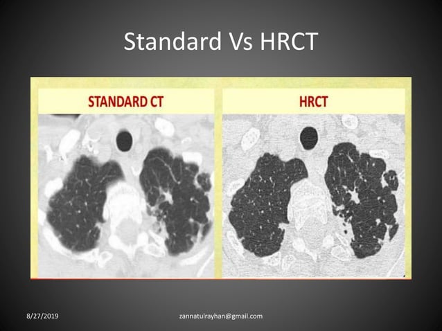 Basics of CT Chest | PPTX