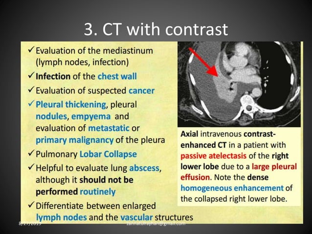 Basics of CT Chest | PPTX