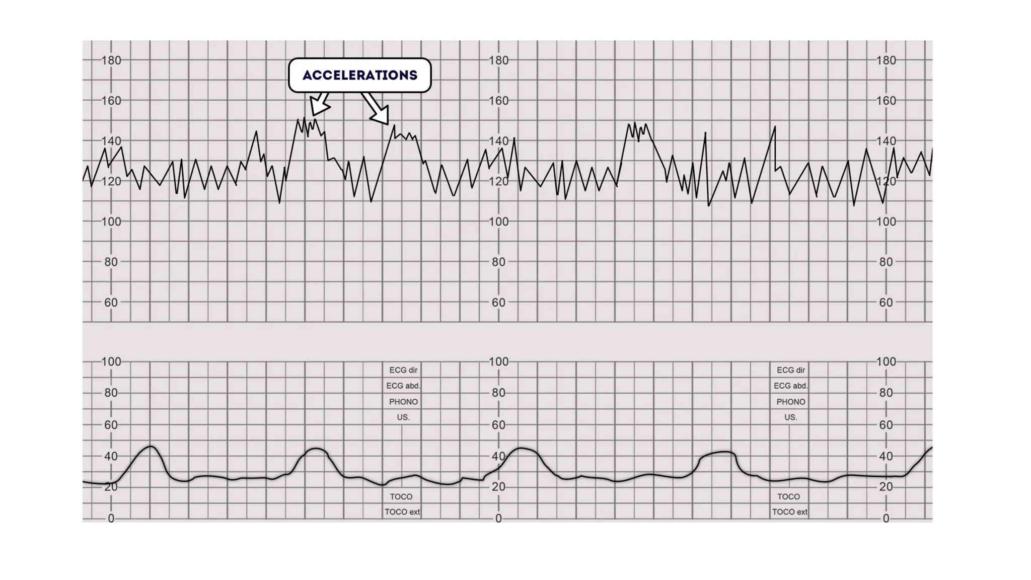 BASICS OF CTG MONITORING INTERPRETATION.pptx