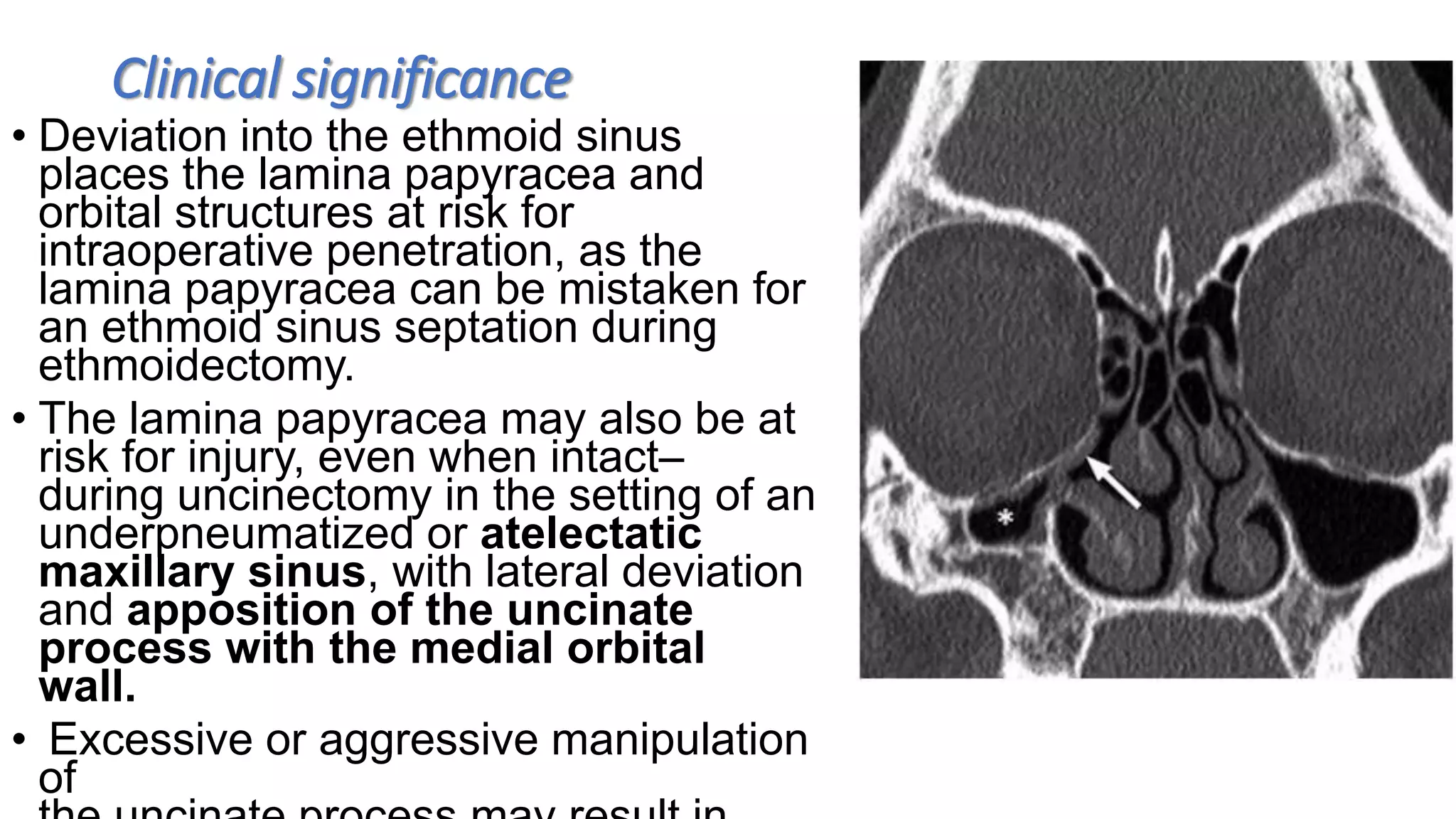 Basics of CT Scan interpretation of paranasal sinuses.pptx