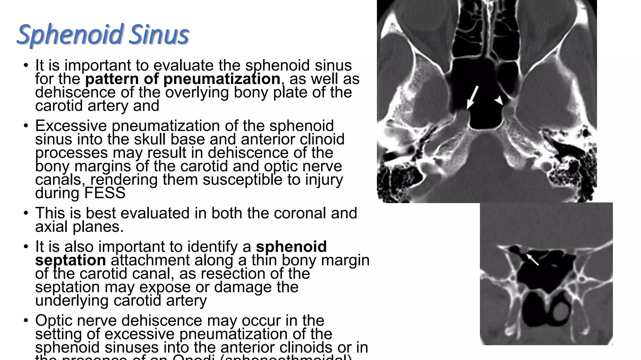 Basics of CT Scan interpretation of paranasal sinuses.pptx
