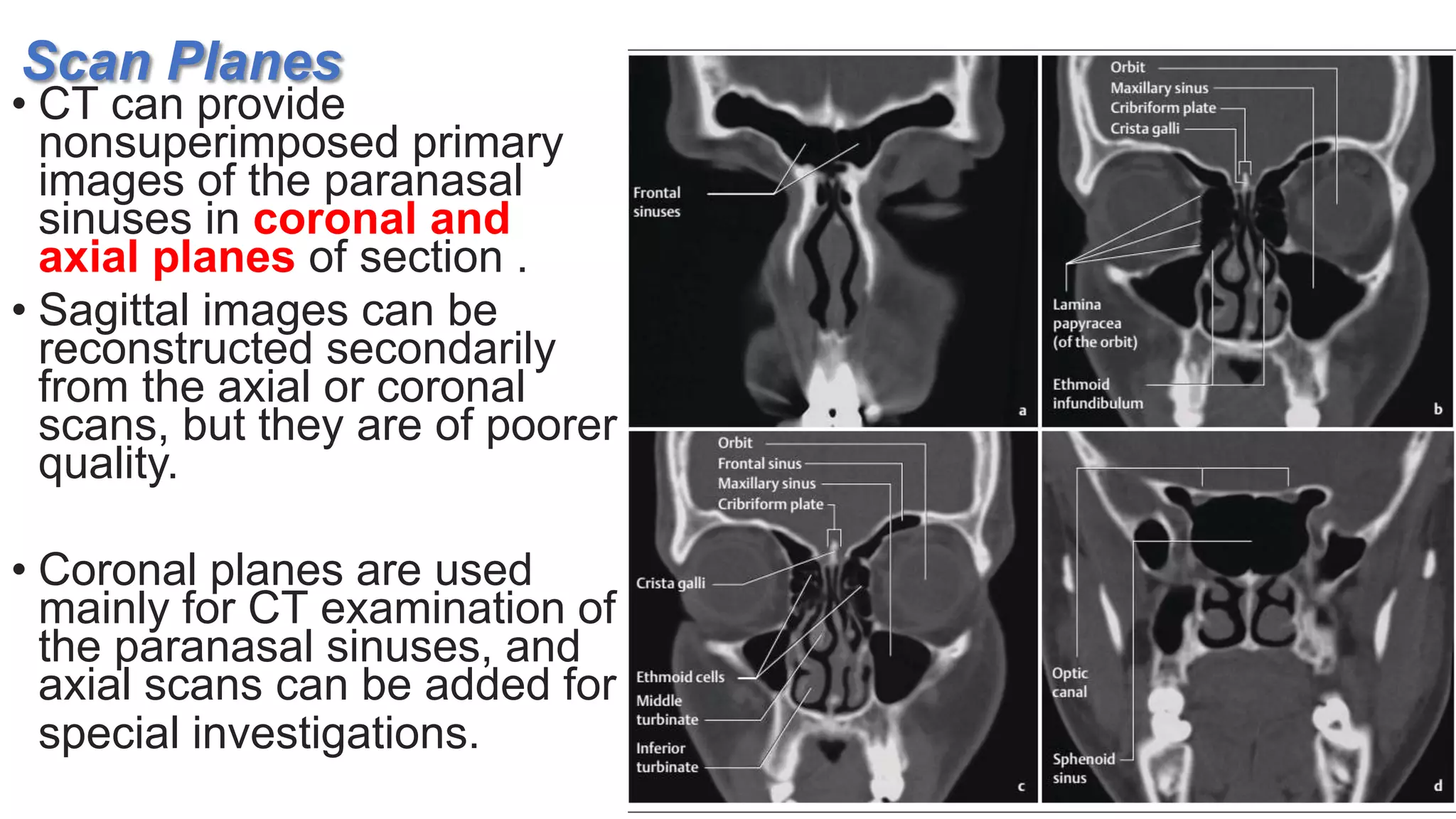 Basics of CT Scan interpretation of paranasal sinuses.pptx