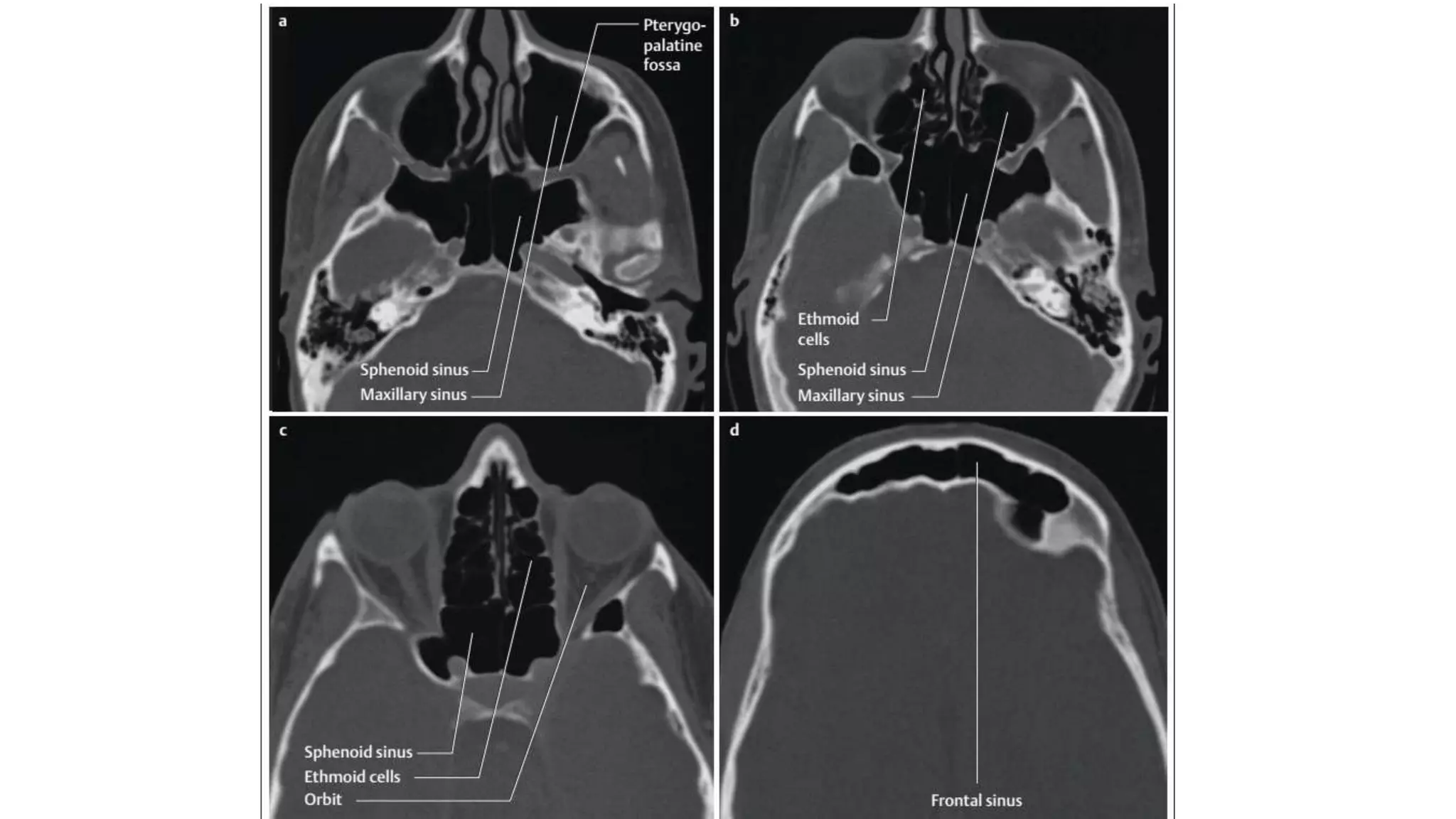 Basics of CT Scan interpretation of paranasal sinuses.pptx