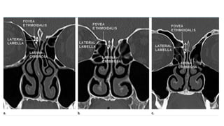 Basics of CT Scan interpretation of paranasal sinuses.pptx