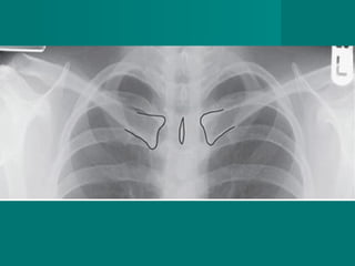 Basics Of CXR interpretation www.radiologydefinition.com