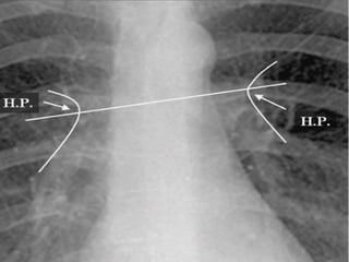 Basics Of CXR interpretation www.radiologydefinition.com