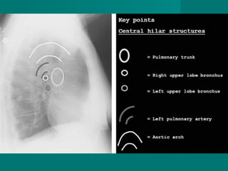 Basics Of CXR interpretation www.radiologydefinition.com